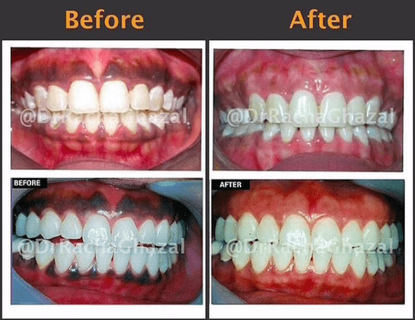 Gum Whitening By Laser